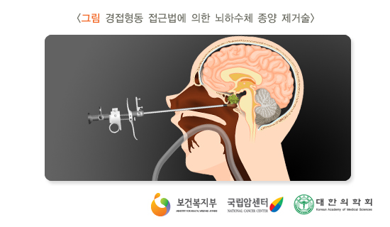 뇌하수체선종경접형동 접근법에 의한 뇌하수체 종양 제거술 네이버 블로그