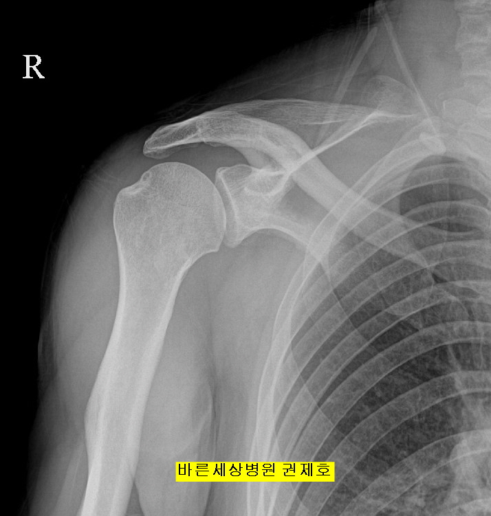 외상성 회전근개파열 관절경 회전근개 이중봉합술 앞으로 넘어지면서 우측 어깨로 착지 후 생긴 어깨인대파열 치료 방법 서울바른