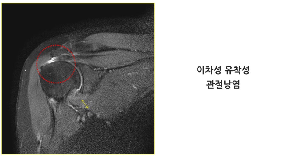 오십견유착성 관절낭염 동결견 치료방법 네이버 블로그