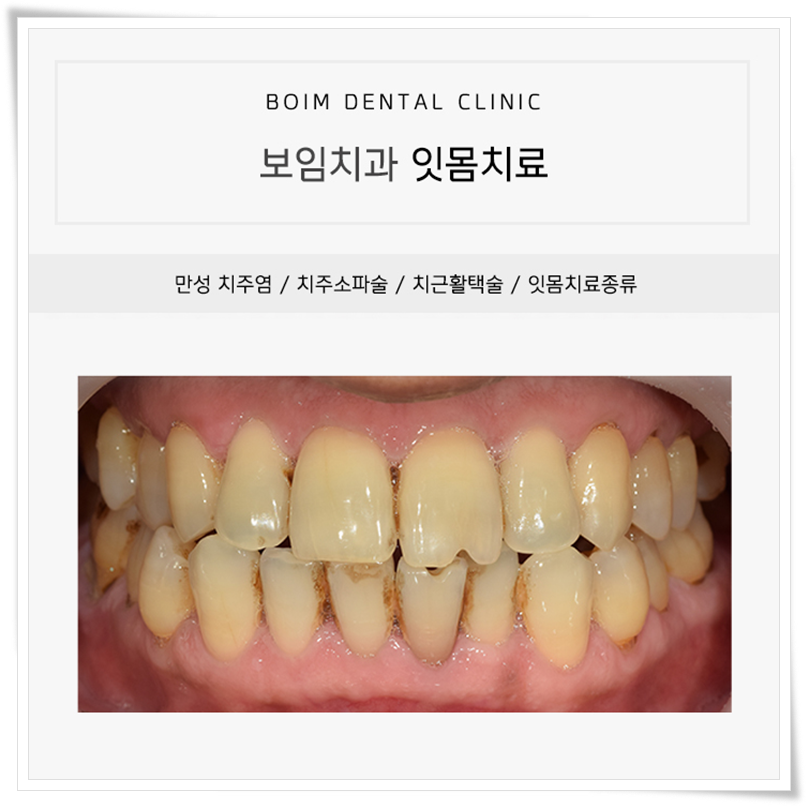 만성 치주염 치료 잇몸치료종류스케일링치근활택술치주소파술 네이버 블로그