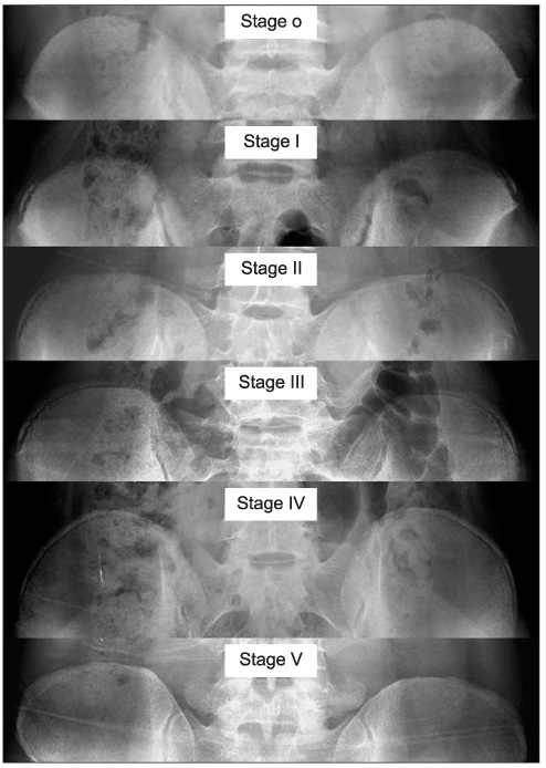 Risser sign : 네이버 블로그