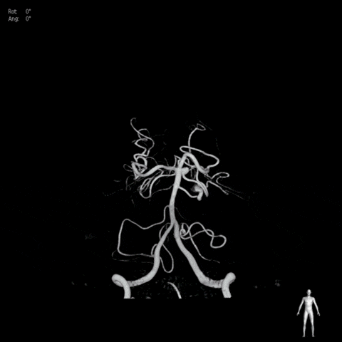 뇌혈관조영술[TFCA : Transfemoral cerebral angiography] : 네이버 블로그
