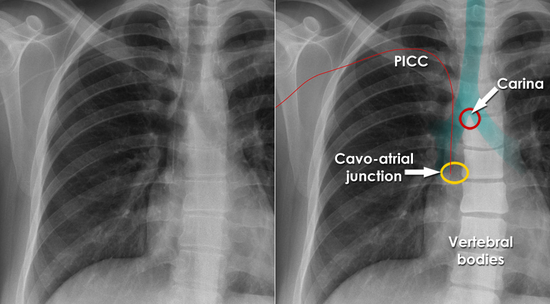 X-ray판독법 (tube) : 네이버 블로그