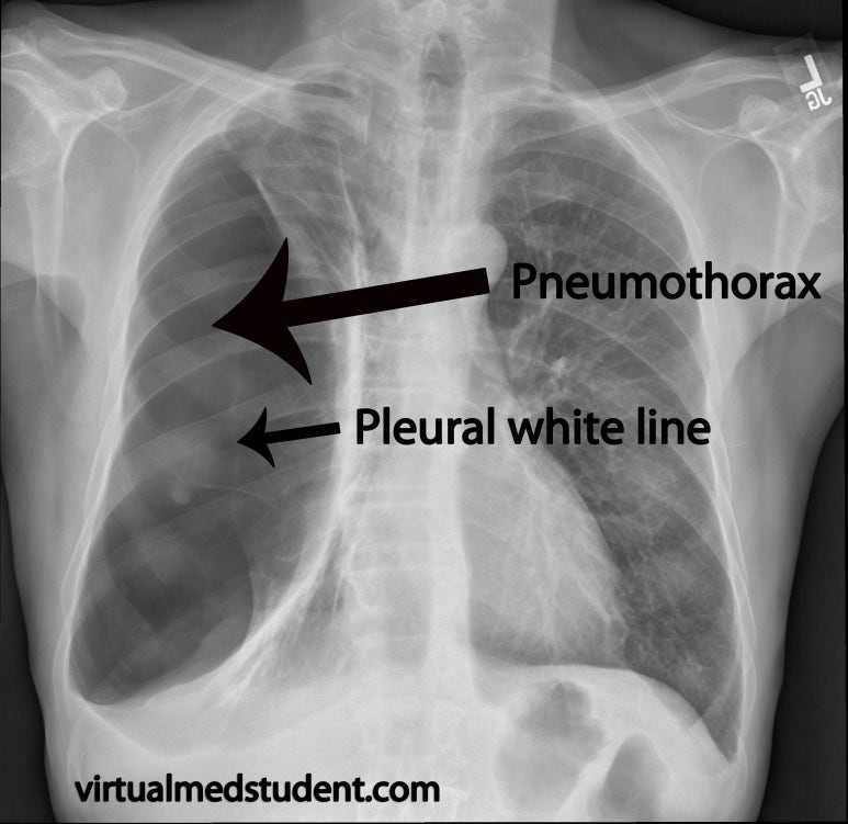 기흉 pneumothorax : 네이버 블로그